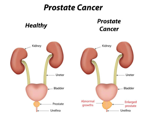Cancer de prostata | OncoFort